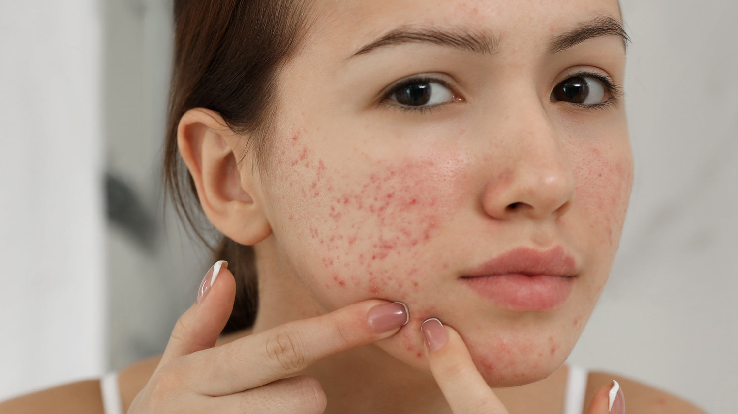 The Difference Between Hormonal and Cystic Acne – PharmaHealth UAE